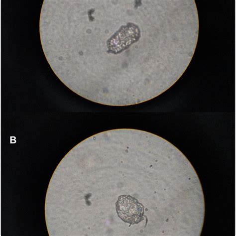 Skin Scraping On Microscopy A Scabies Ova B Scabies Mites Download Scientific Diagram