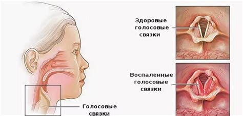 Лечение ларингита в домашних условиях у взрослых