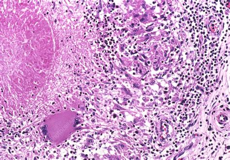 Pulmonary Tuberculosis Light Micrograph Stock Image C001 8827