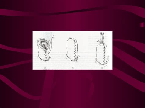 Abdominal Wall Defects