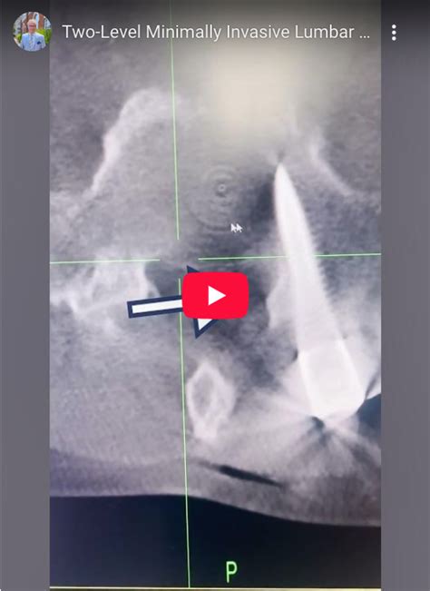 Two Level Minimally Invasive Lumbar Fusion William Capicotto Md Pc