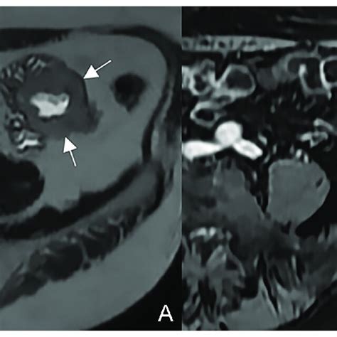 Example Of Gist In An Old Man With Abdominal Discomfort And A Palpable