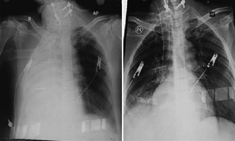 A Chest X Ray Anteroposterior View Showing Right Sided Complete Lung