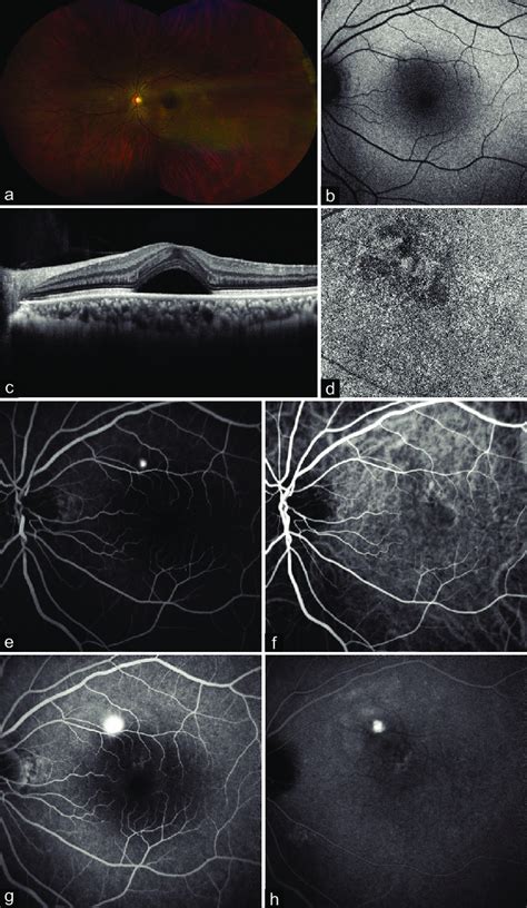 Multimodal Imaging Of A 46 Year Old Male Patient With Csc A The Download Scientific Diagram