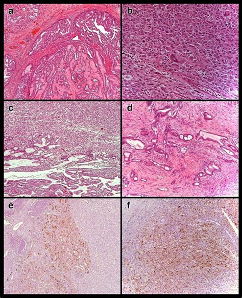 Microscopic Findings A The Carcinoma Component With Tubular Glandular