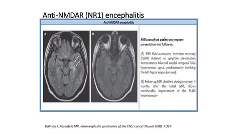 Anti Nmda Receptor Encephalitis Copy Pptx