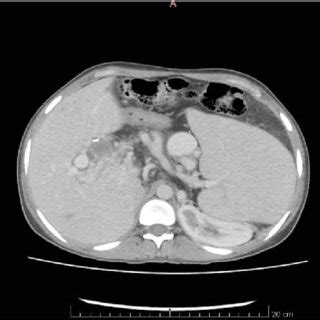CT Scan Coronal View Showing Gross Hepatosplenomegaly With Large
