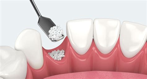 Alasan Bone Graft Solusi Terbaik Untuk Regenerasi Tulang