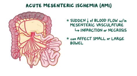 Acute Mesenteric Ischemia Video And Meaning Osmosis