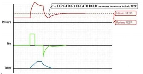 Intrinsic Peep • Litfl • Ccc Ventilation