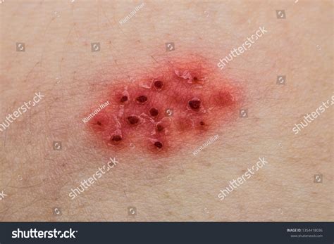 Shingles Scabs