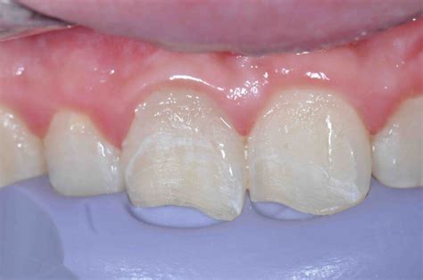 Class Four Composite Restoration Lee Ann Brady Dmd