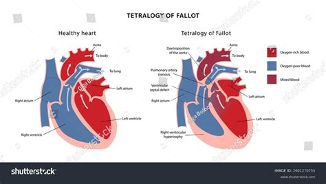 Tetralogy Fallot Cardiac Anomalies Pulmonary Artery Stock Vector