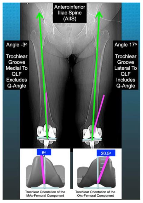The Trochlear Groove Of A Femoral Component Designed For Kinematic Alignment Is Lateral To The
