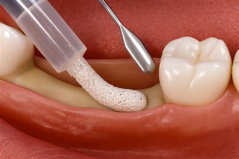 D7311 Alveoloplasty Dental Code For A Smooth Recovery Lema