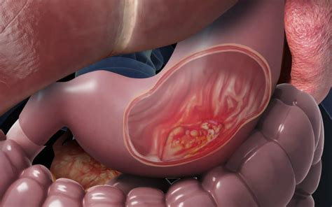 Good Vs Bad Gut Bacteria