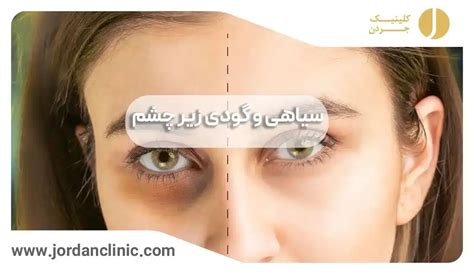 علت و 14 درمان سیاهی و گودی زیر چشم کلینیک جردن
