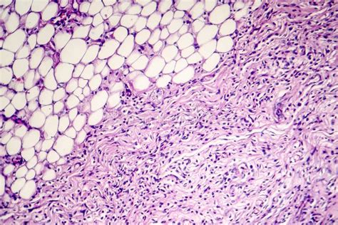 Pericarditis Ljus Micrograph Foto Under Mikroskopet Arkivfoto Bild