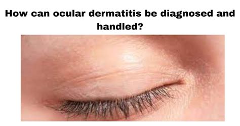How Can Ocular Dermatitis Be Diagnosed And Handled