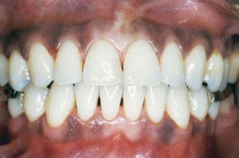 Periodontology Ch 5 Periodontal Health And Gingival DIseases Conditions Flashcards Quizlet