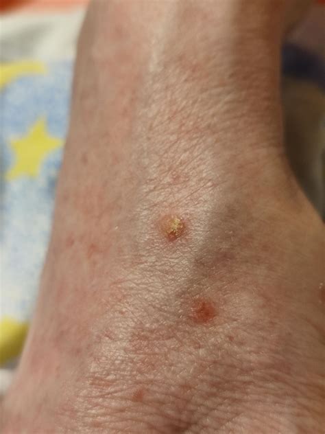 What Is This Bump On My Moms Hand R Dermatologyquestions