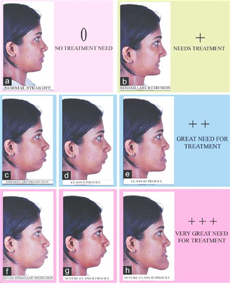 Facial Aesthetic Index Chart Female 0 ‑ No Treatment Need