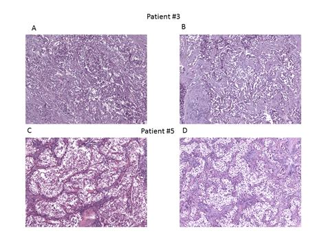 Transcriptomic Analysis And Mutational Status Of Idh1 In Paired Primary