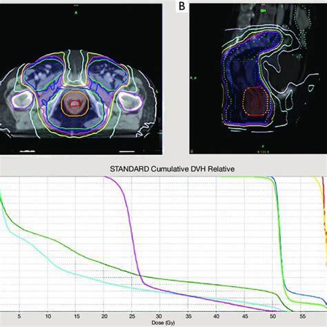 Simultaneous Integrated Boost Intensity Modulated Radiotherapy Download Scientific Diagram