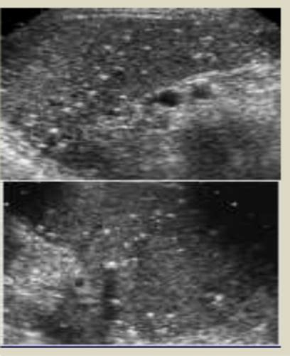 Spleen Pathology Images Unit 6 Flashcards Quizlet