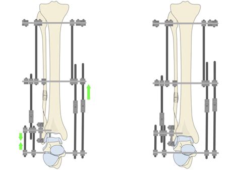 correction of fibula deformity and lateral subluxation reduction
