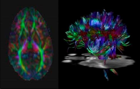 Diffusion Tensor Imaging Data A Color Coded Anisotropy Map Left Download Scientific Diagram