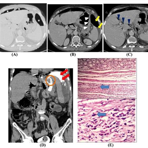 Scaphoid Fracture Classification According To Herbert And Fischer Download Scientific Diagram