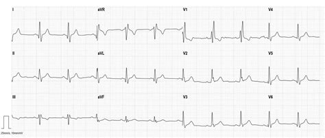 Right Bundle Branch Block Ecg Guru Instructor Resources