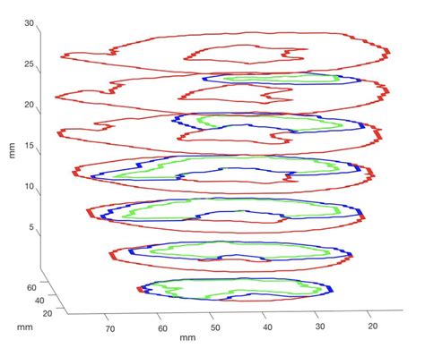 Lad Infarct Manual Tracings From A Postmortem Excised Lv Part A Download Scientific Diagram
