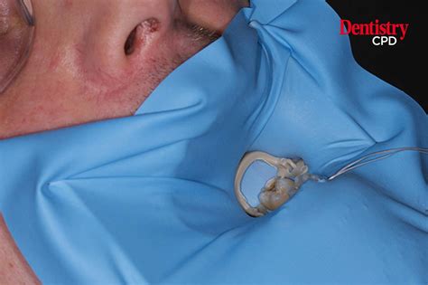 Dentistry Cpd Back To Basics Rubber Dam Isolation