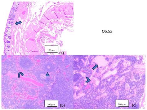 Giant Appendiceal Mucocele With High Grade Mucinous Neoplasm Case