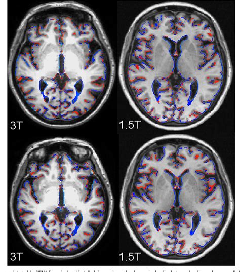 The Sienafsl Whole Brain Atrophy Algorithm Is No More Reproducible At
