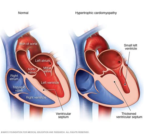Hypertrophic Cardiomyopathy Hcm For Short Hcm Beat