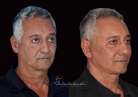 Lower Eyelid Surgery Jalalabadi Plastic Surgery