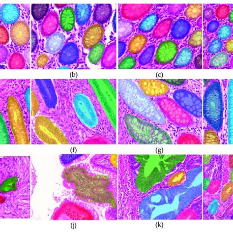 Pdf Segmentation And Grade Prediction Of Colon Cancer Digital
