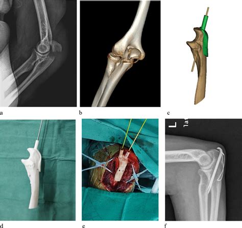 A 49 Year Old Man Treated With Individualized 3d Printed Template Download Scientific Diagram