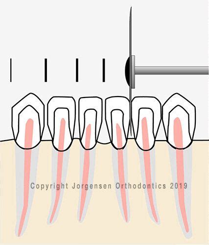 What Is Interproximal Reduction In Orthodontics Orthodontics Orthodontist Invisalign