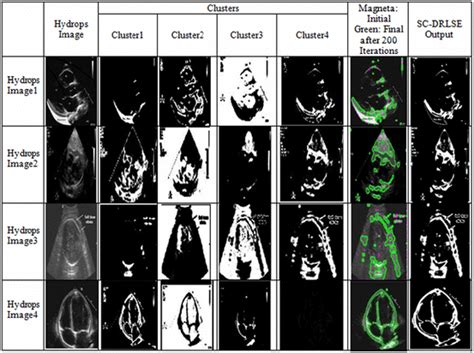 Processed Hydrops Images Using Sc Drlse Algorithm Download Scientific Diagram