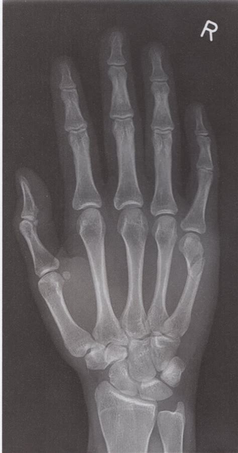 Metacarpophalangeal Joint Fracture