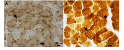 Figure 2 From Expanding The Clinical Spectrum Of Ubtf Related Neurodevelopmental Disorder
