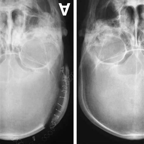 A Radiograph Showing That The Left Superior Edge Of The Bone Flap Had Download Scientific