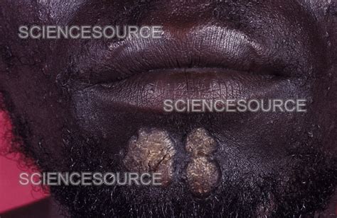 Secondary Syphilis Stock Image Science Source Images