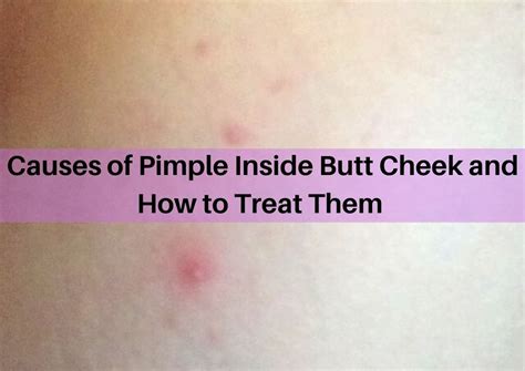 Causes Of Pimple Inside Buttcheek And How To Treat Them