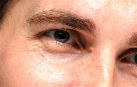 Til That While Filming The Dark Knight Christian Bales Eye Wart Cut