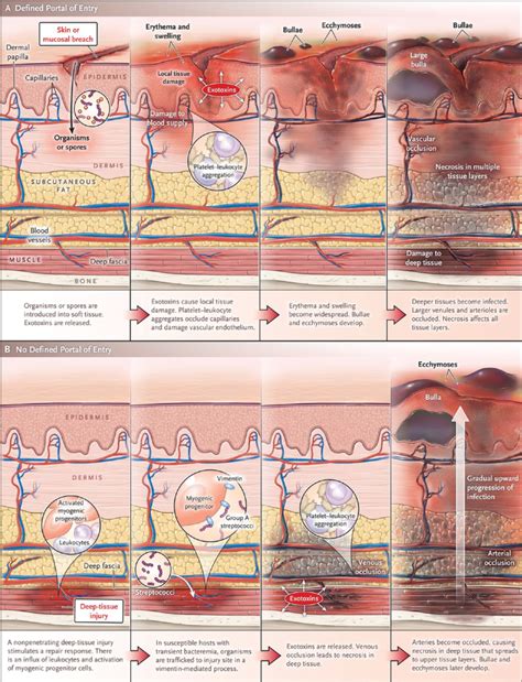 Pediatric Necrotizing Fasciitis Journal Of The Pediatric Orthopaedic Society Of North America